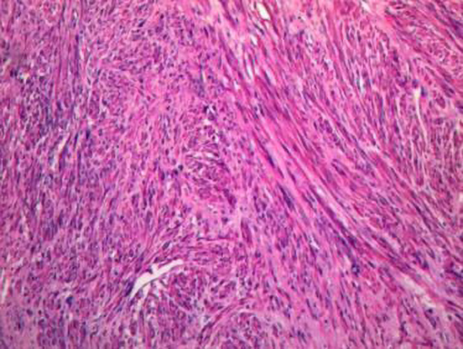 Resected surgical specimen showing externally smooth bosselated soft ...